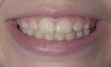 Invisalign for Kids in London: Invisible Braces for Your Child's Smile ...