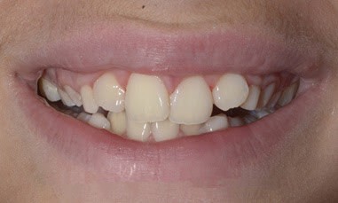 Invisalign for Teens | Comfortable & Confident Smiles | Boston Orthodontics